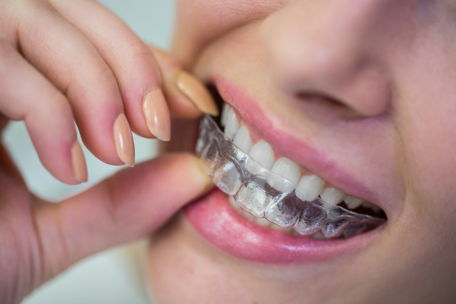 Know Tips and Care of Invisalign® | Family Dentist Sarnia